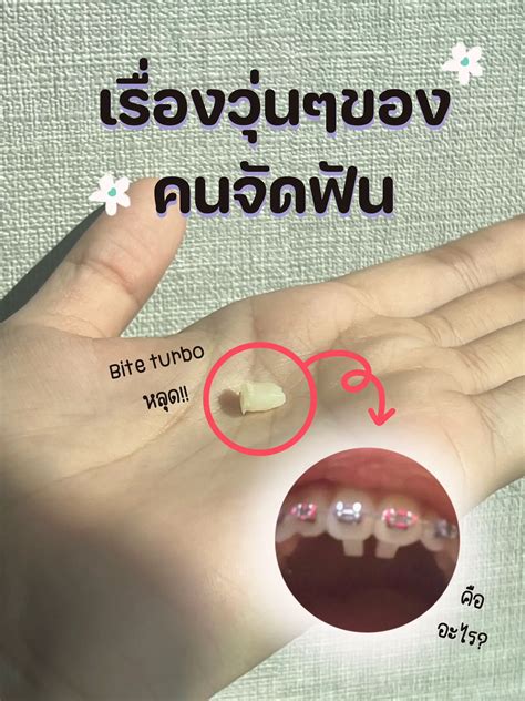 เรื่องวุ่นๆของคนจัดฟัน🦷 แกลเลอรีที่โพสต์โดย พิ้กกุลรีวิว Lemon8