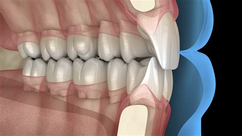 What Is Normal Dental Occlusion At Darcy Spaull Blog