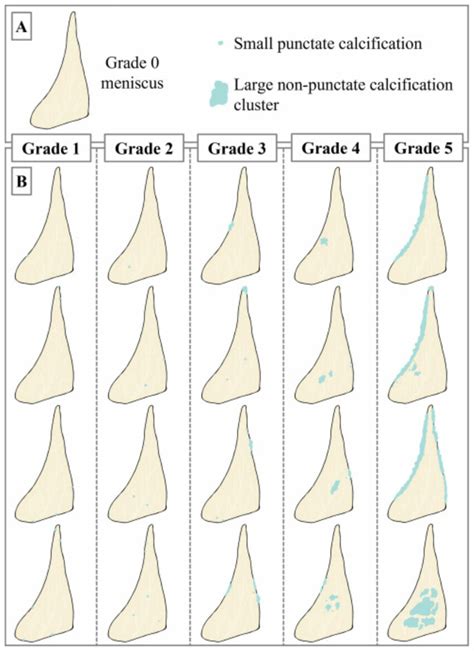 Calcification Grades A Left An Example Illustration Of Grade 0