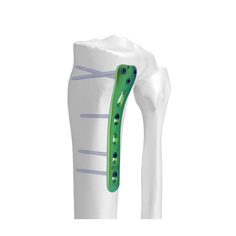 Posterior Medial Proximal Tibial Platemedical Device Manufacturers