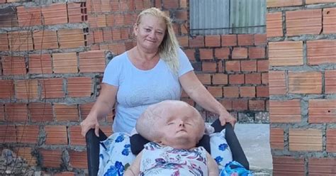 Mãe De Mulher Com Hidrocefalia Gigante Exibe Sua Rotina Com A Filha E