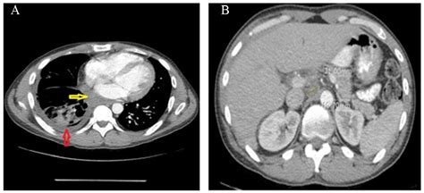 Chemotherapy And Immune Checkpoint Inhibitors In A Case Of Smarca4 Dut