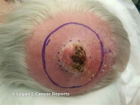 Pleomorphic Dermal Sarcoma Images