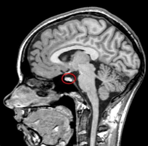 T1 Weighted Mri Of Her Pituitary With Contrast Showing Normal