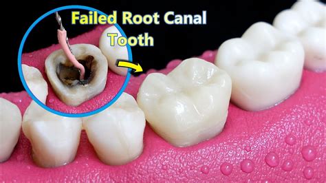 failed root canal teeth at nicholas warrior blog