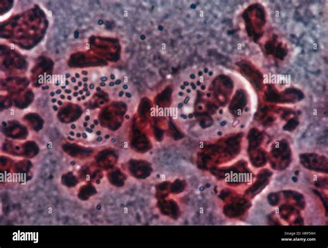 Neisseria Gonorrhoeae Microscope A 34 Year Old Man With Urethral