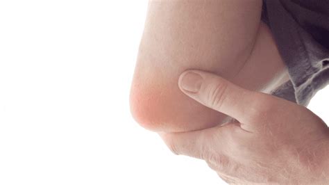 Olecranon Bursitis Causes Symptoms Treatment Olecranon Pin On
