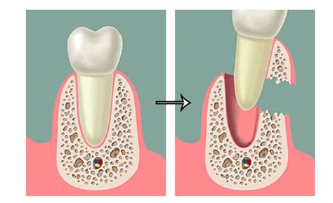 Резорбция костной ткани факторы усиления процесса Недорогая Стоматология в Москве