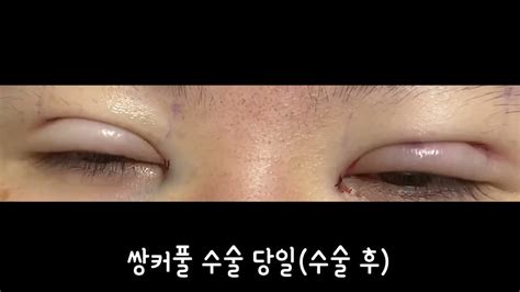 쌍수 Vlog 쌍수 후 100일간의 붓기 변화비절개 눈매교정 매몰법 눈 지방제거 몽고주름 제거 앞트임 Youtube
