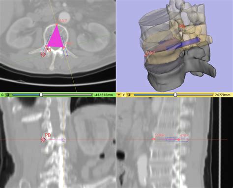 github jumbojing pediclescrewsimulator 1 3d slicer module for