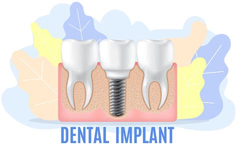 정상적인 건강한 치아와 치과 임플란트 구조 위의 잇몸에 보철물을 가진 인간의 턱 건강관리와 의술에 대한 스톡 벡터 아트 및 기타 이미지 건강관리와 의술 금속 나사
