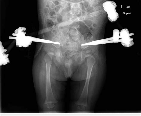 Postoperative Plain Radiograph Download Scientific Diagram