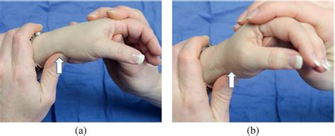 Occult Scaphoid Fractures Anesthesia Key Occult Scaphoid Fractures Anesthesia Key