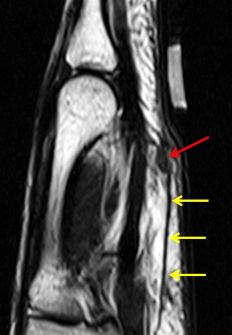 Dupuytrens Disease Radsource