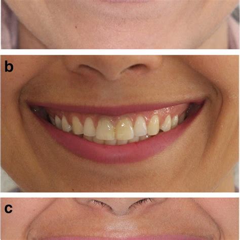 Classification Of Altered Passive Eruption Download Table