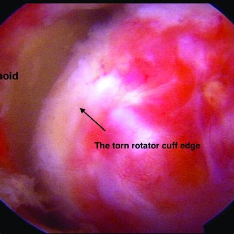 Illustration Of Arthroscopic Transosseous Superior Capsular Download Scientific Diagram
