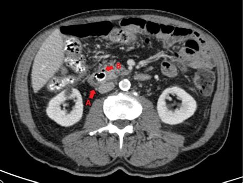 Cystic Duct Carcinoma After Laparoscopic Cholecystectomy Ca Il