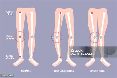 외반 기형의 3d 아이소메트릭 플랫 벡터 개념 그림 3차원 형태에 대한 스톡 벡터 아트 및 기타 이미지 3차원 형태 개념 관절 Istock
