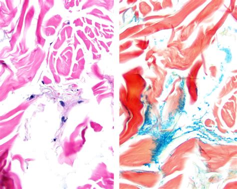 Scleroderma