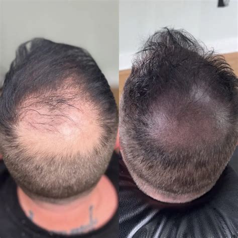 Scalp Pigmentation Cosmetic Ink Studios Scalp Pigmentation Cosmetic Ink Studios