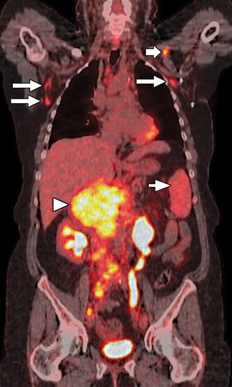 Pet Scan Lymphoma