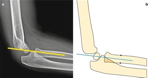 Radiocapitellar Line Wikism Sports Medicine Wiki