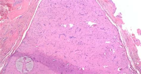 Angioleiomyoma Histology Image