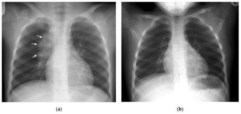 Tuberculosis Vs Pneumonia X Ray