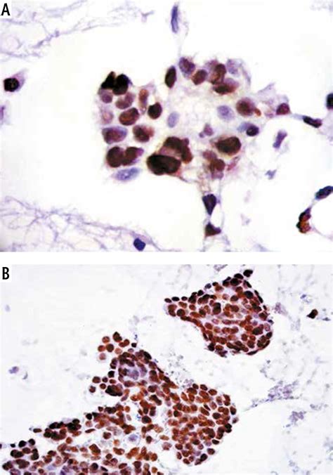 Predictors For Hepatocellular Carcinoma Recurrence After Microwave Ablation