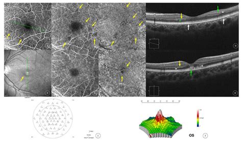 Diagnostics Special Issue Whats New In Retinal Imaging