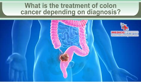 Is Colon Cancer Curable Things You Need To Know