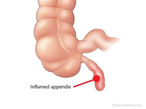 Appendicitis Causes Symptoms And Treatment Options Appendicitis Causes Symptoms And Treatment Options