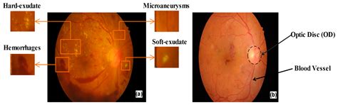 Classification And Segmentation Of Diabetic Retinopathy A Systemic Review