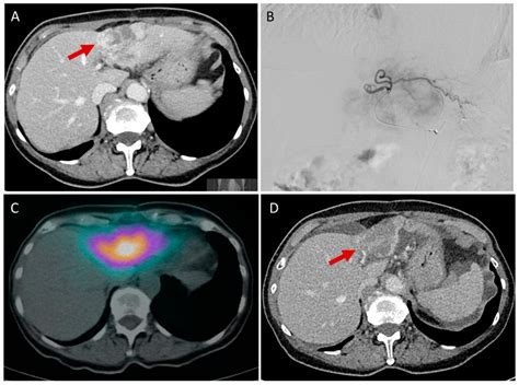 Example Of Intrahepatic Cca In Liver Segments Ii And Iii With Vital Download Scientific Diagram