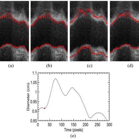 The Ascending Aorta Diameter Waveform Extraction Process A Anterior