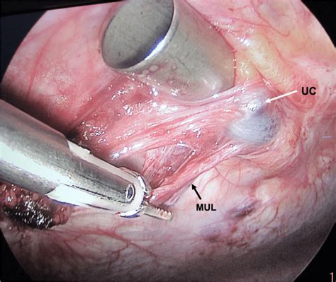Laparoscopic Excision Of A Symptomatic Urachal Cyst Uc In An Adult Pmc