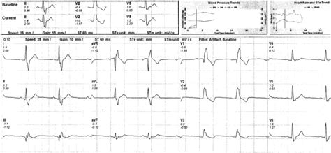 Right Bundle Branch Block Is Present Download Scientific Diagram