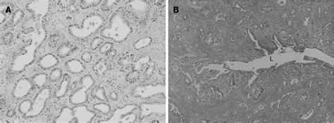 Figure 2 From Pathological Classification Of Intrahepatic