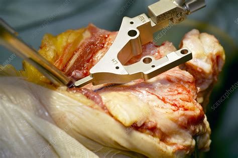 Elbow Replacement Surgery Stock Image M5510408 Science Photo Library