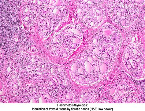 Pathology Outlines Hashimoto Thyroiditis
