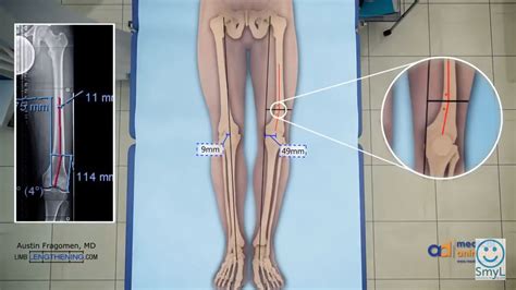 Can You Get Leg Shortening Surgery At Evan North Blog