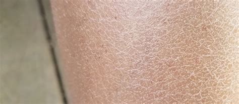 Epilyt Lotion For Dry Skin Canada Drugs Direct