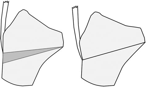 Anterior Openingwedge Osteotomy The Osteotomy Starts Directly Under Download Scientific