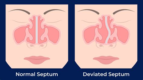 Deviated Septum Surgery Everything You Need To Know
