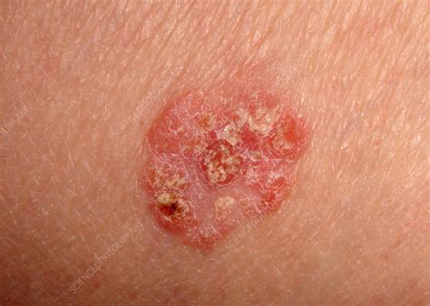 Is Bowens Disease Fatal Bowens Disease Symptoms Causes And