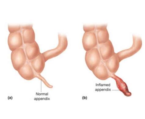 Normal And Inflamed Appendix Dssurgery