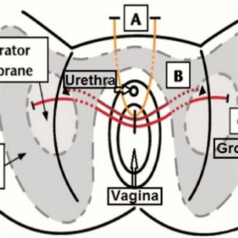Table From The Vaginally Inserted Synthetic Mesh Potential Download Table