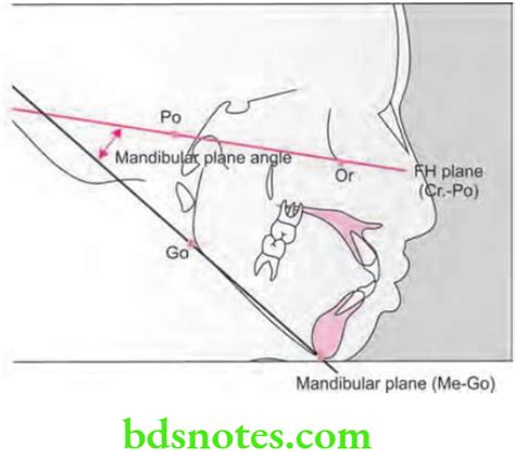Understanding The Skeletal Parameters Of Downs Analysis In
