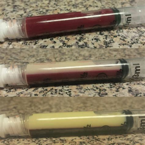 Hypertriglyceridemia 1500mgdl Resulting In Pancreatitis Photos Are