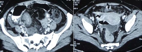 A Cect Axial Image Shows Diffuse Symmetric Mural Thickening In Ileal A Cect Axial Image Shows Diffuse Symmetric Mural Thickening In Ileal